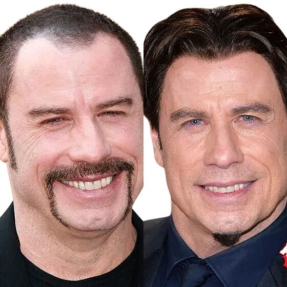 10 Open Celebrity Hair Transplant Journeys That Inspire Confidence